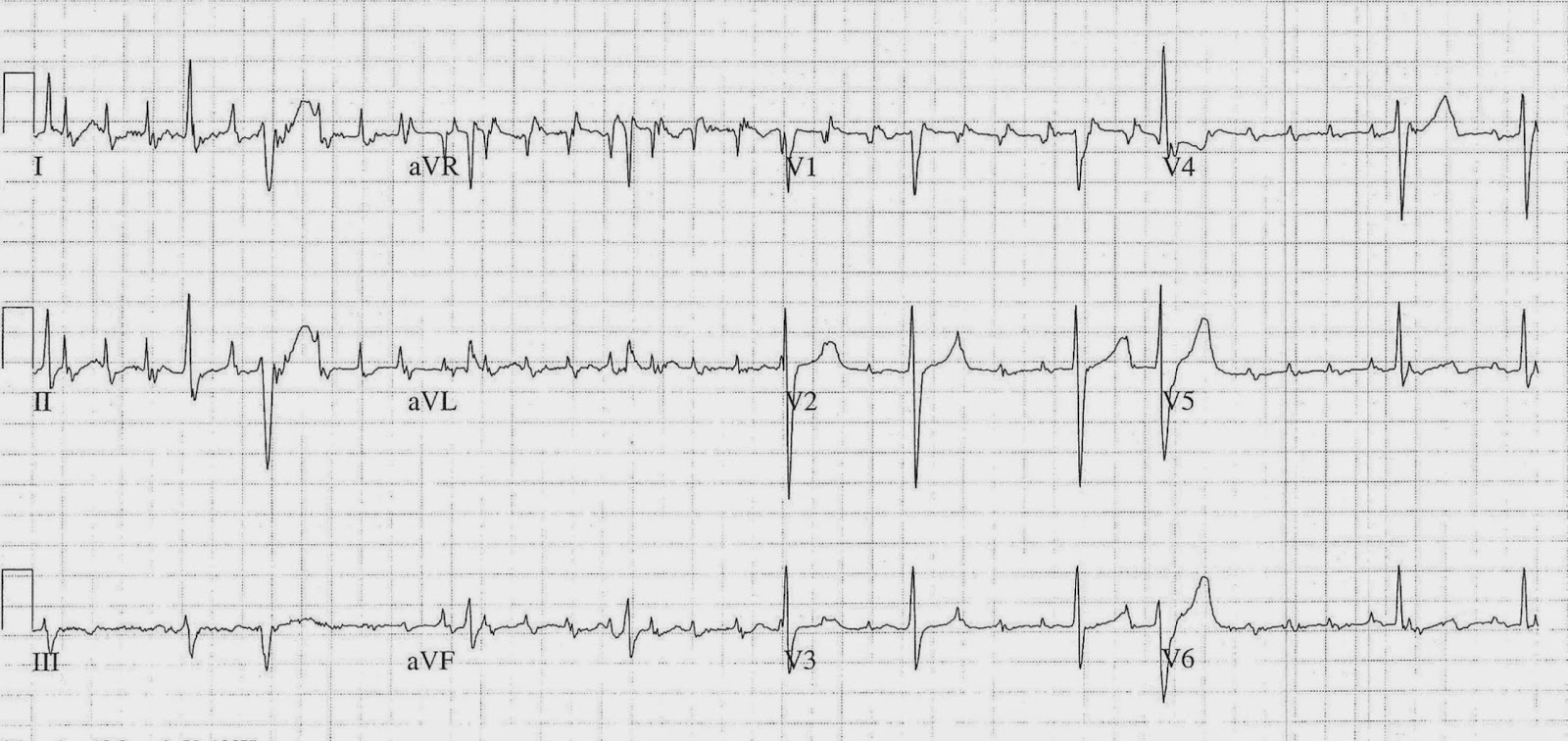 ECG of the Week: ECG of the Week - 16th June 2014 - Interpretation