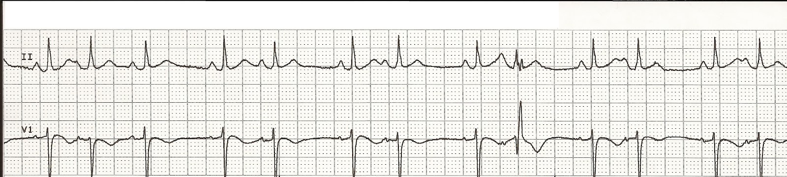 EKG Rhythm Strip Quiz 17