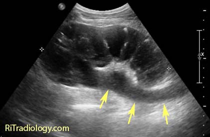 RiT radiology: Pyonephrosis