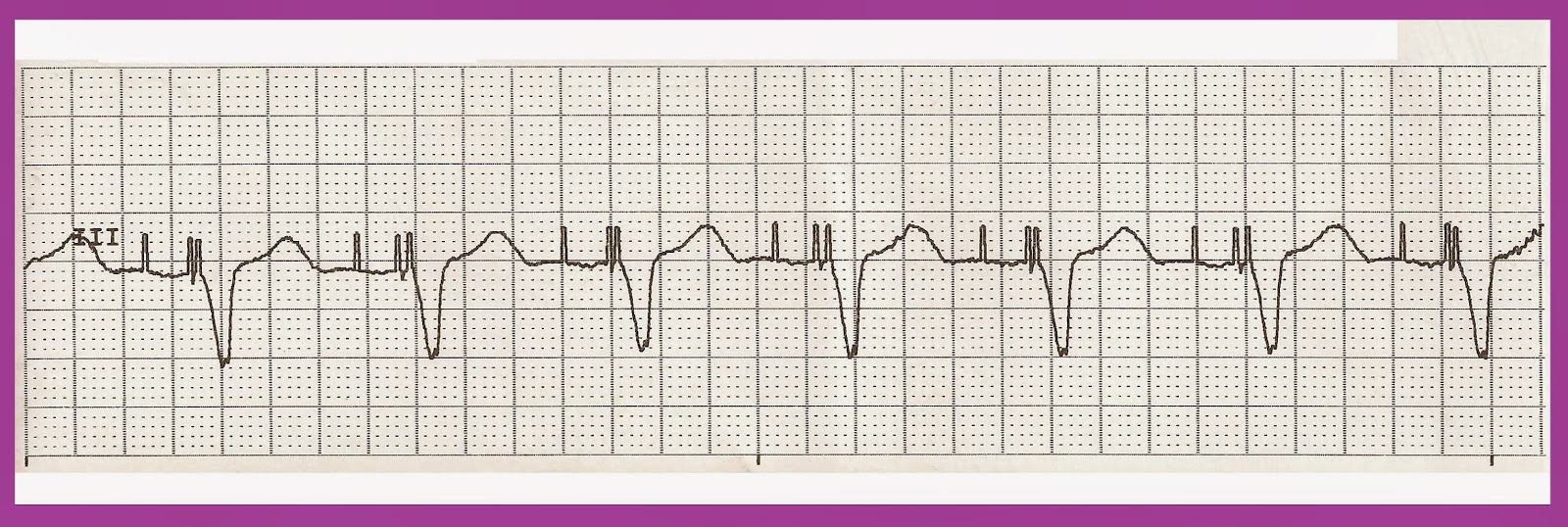 EKG Rhythm Strip Quiz 189