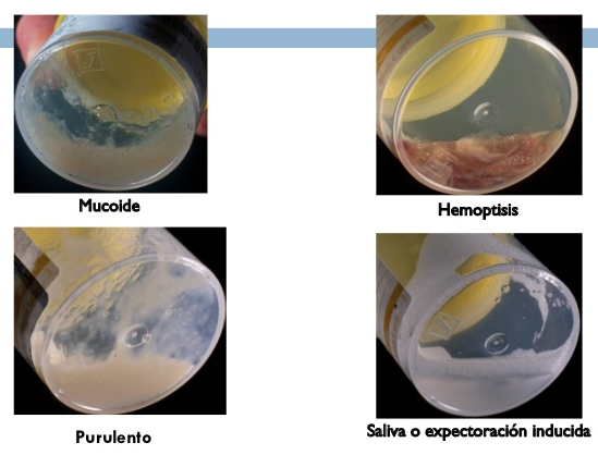 PRUEBAS DIAGNÓSTICAS: Recogida de muestras de esputo