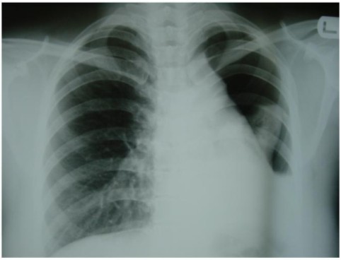 SCIENCE 10 AND BIOLOGY 12: Collapsed Lung