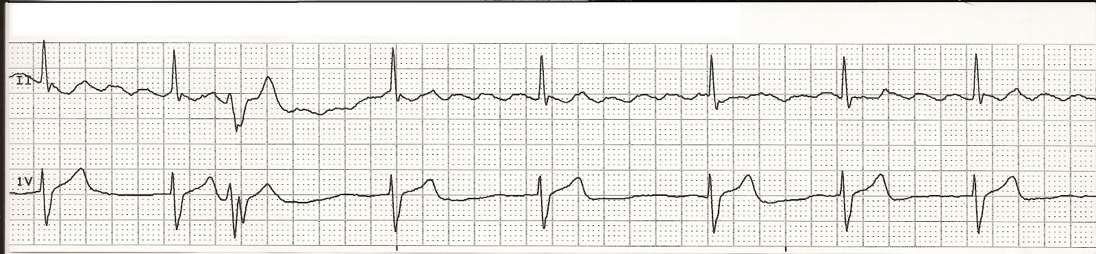 EKG Rhythm Strip Quiz 18
