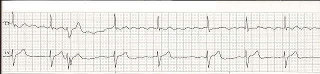 EKG Rhythm Strip Quiz 18