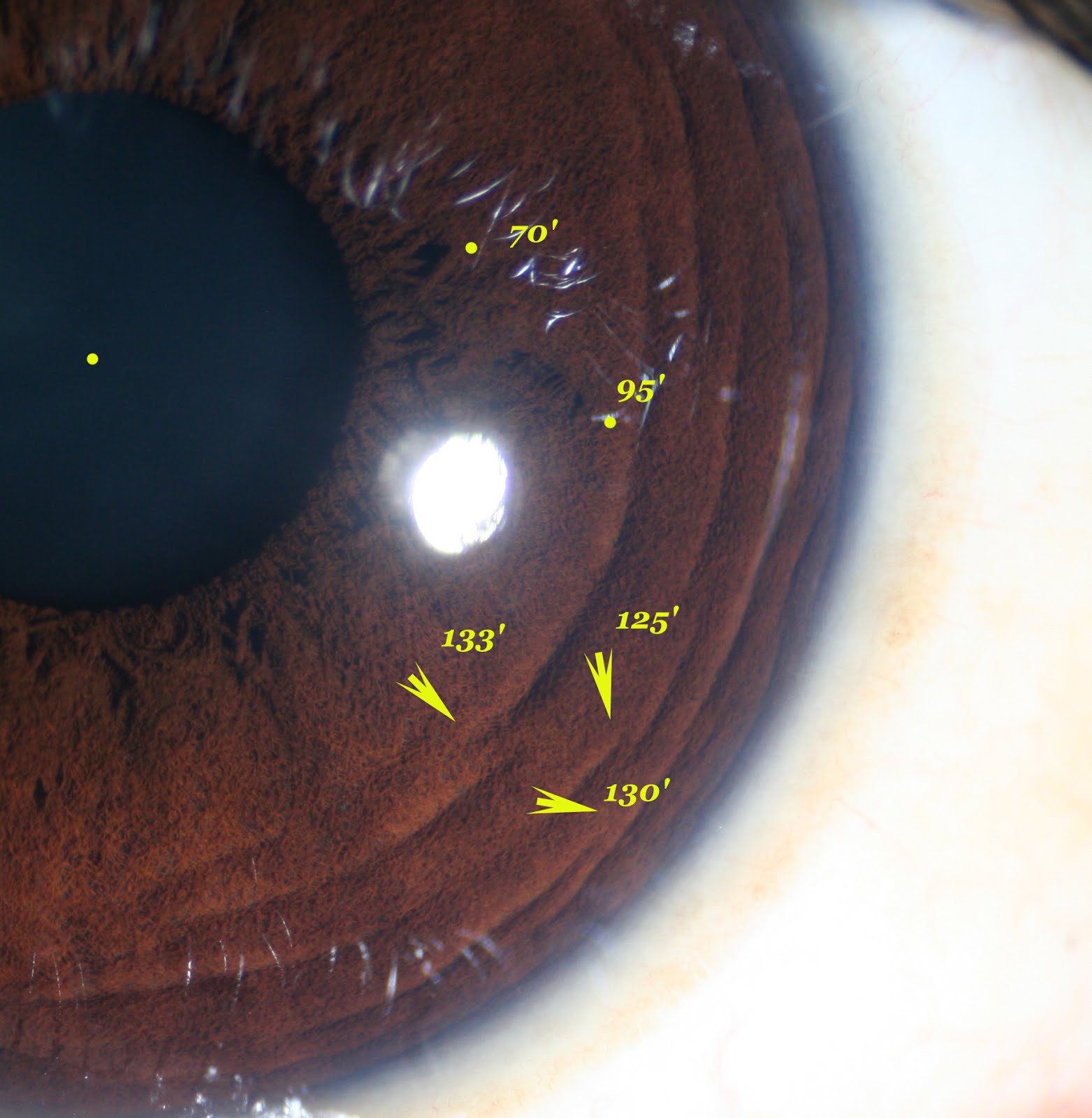 Modern & Multidimensional Iridology: Solitary Melanin Pigment at Inner ...