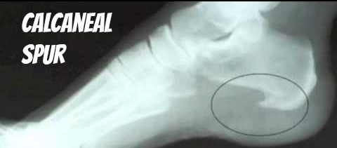 Calcaneal Spur
