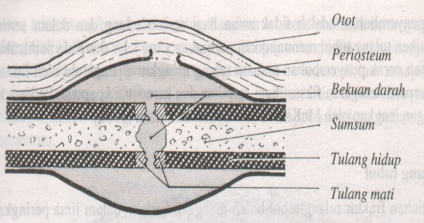 Student's Diaries: PENYEMBUHAN TULANG