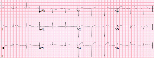 Dr. Smith's ECG Blog: Initial Reperfusion T-waves, Followed by ...