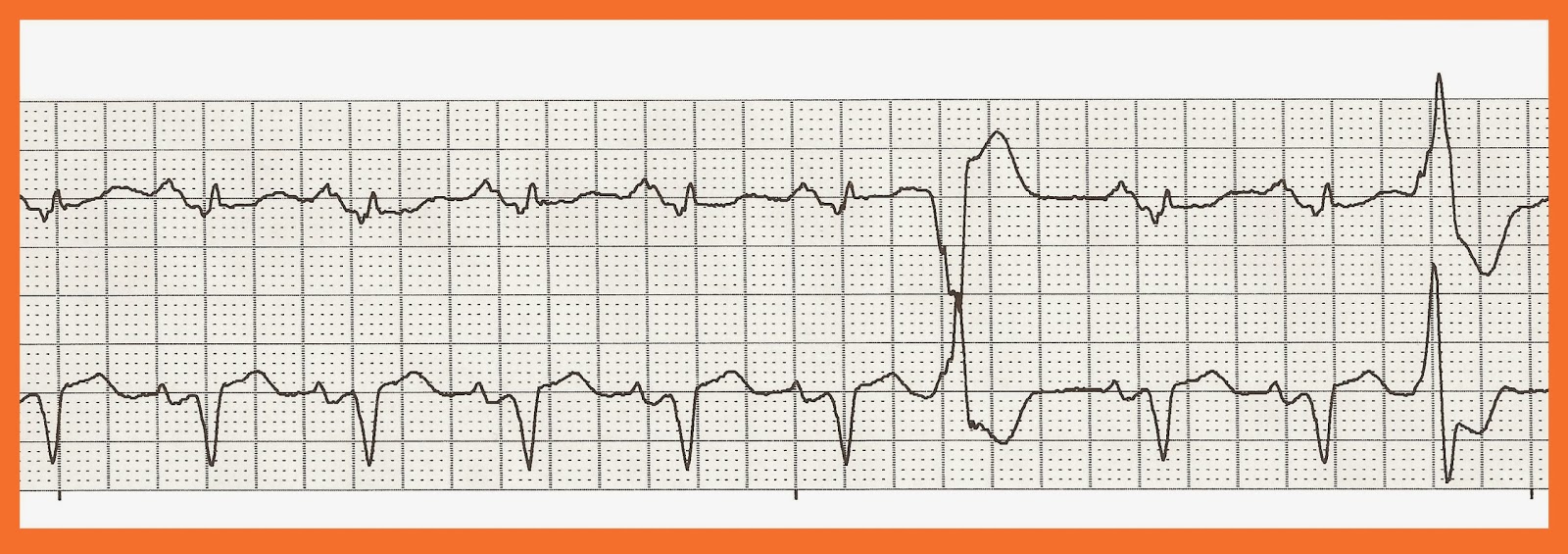 Practice Rhythm Strips 244