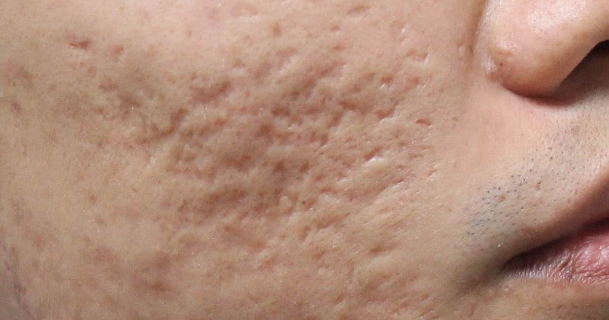 Skintherapy.. Ask the Esthetician: More on Acne Scar Treatments and how ...