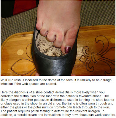 Consultations in Dermatology: Shoe contact dermatitis