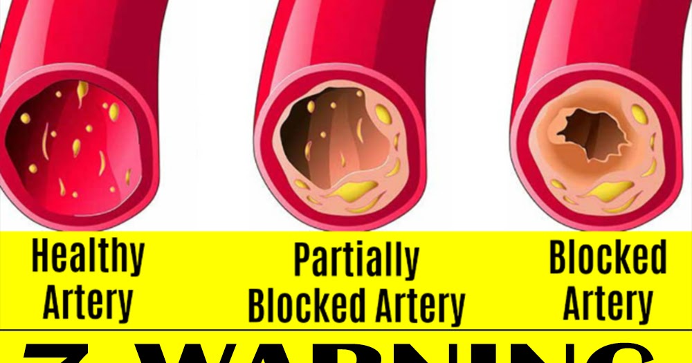 Here Are 7 Warning Signs You Have Blocked Arteries - HEALTH and WELLNESS
