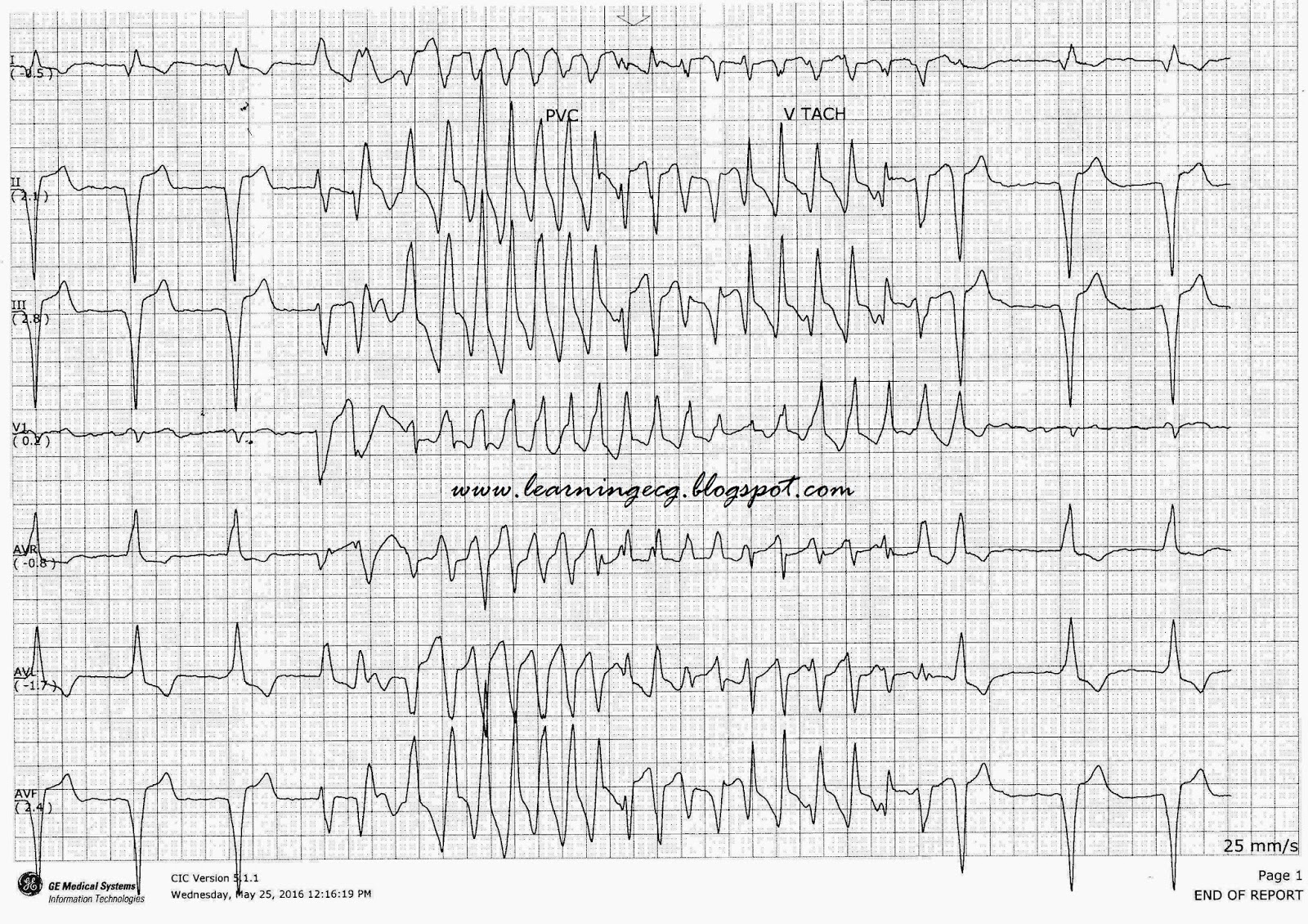 ECG Rhythms: Not all that twist is Torsades de Pointes