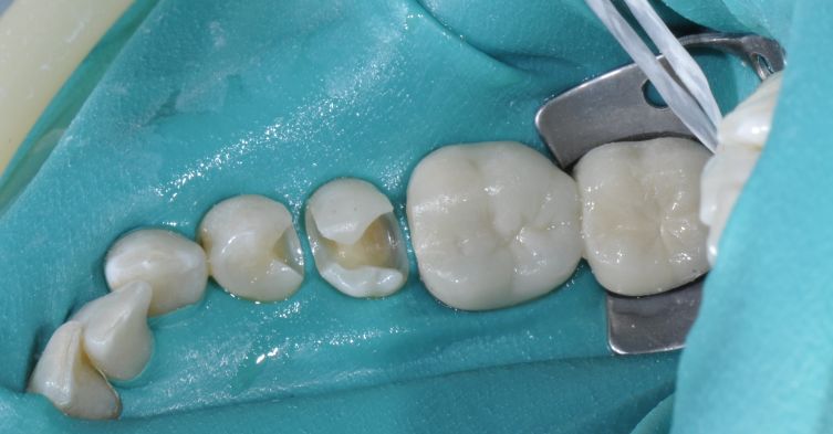 modern dentistry: let's talk about tooth colored fillings...