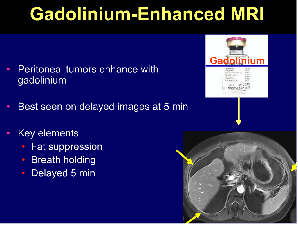 rsna: bowel and peritoneal MRI