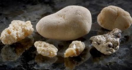 Penyebab Kencing Batu Dan Gejalanya