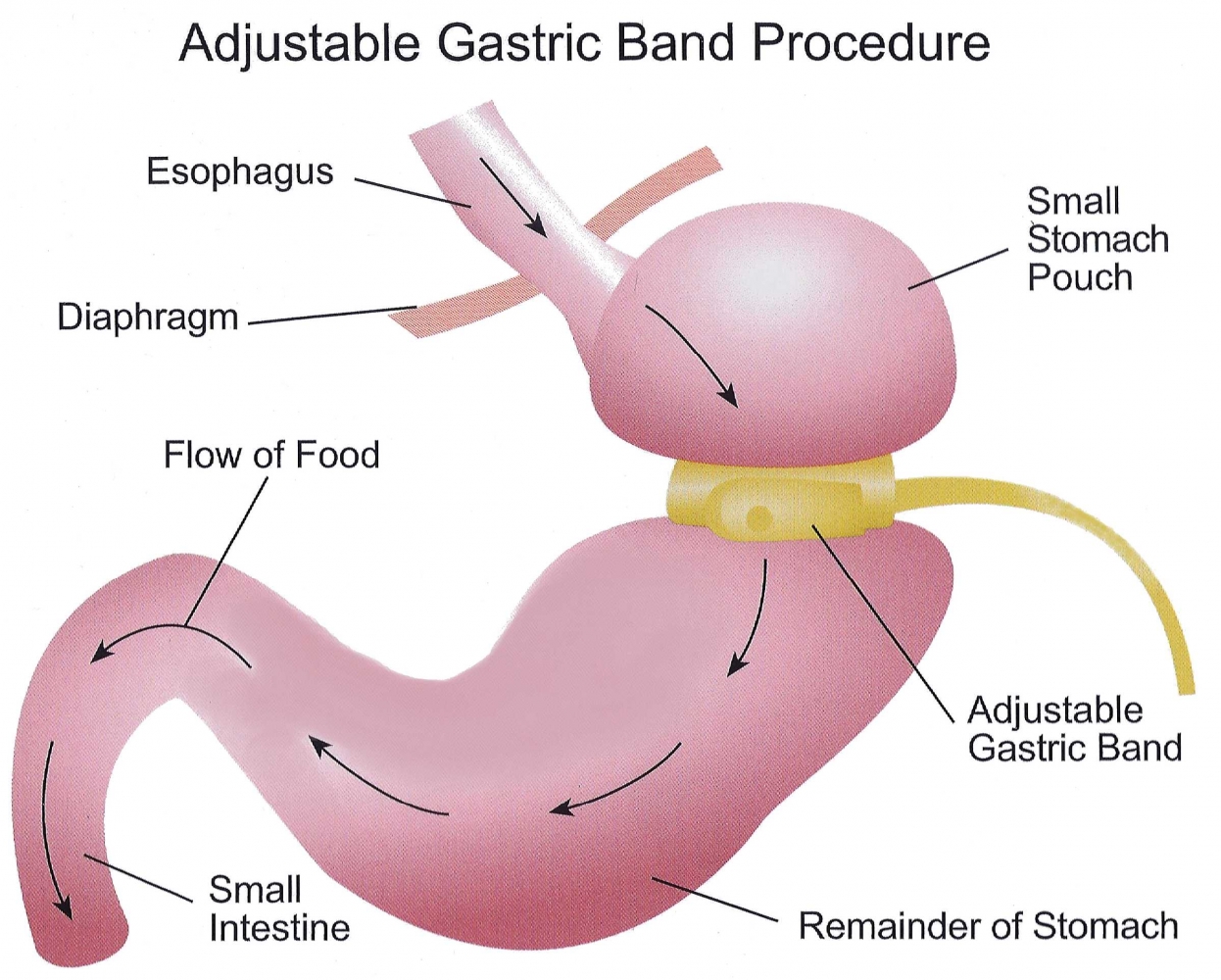 Rawatan Obesiti melalui Pembedahan ~ PERANGI OBESITI!!!