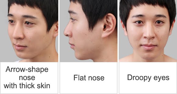 [Real Story] Korean Rhinoplasty Specialized Hospital, Strong and Soft ...