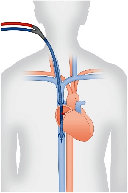 ER goldbook: ECMO (2/6): Vascular Access