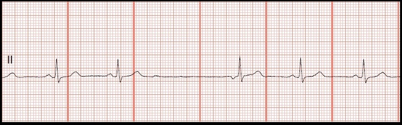 Practice EKG Rhythm Strips 144: Various Escape Beats