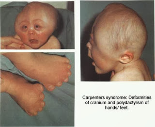 Medical Treatment Pictures-for Better Understanding: Carpenter Syndrome