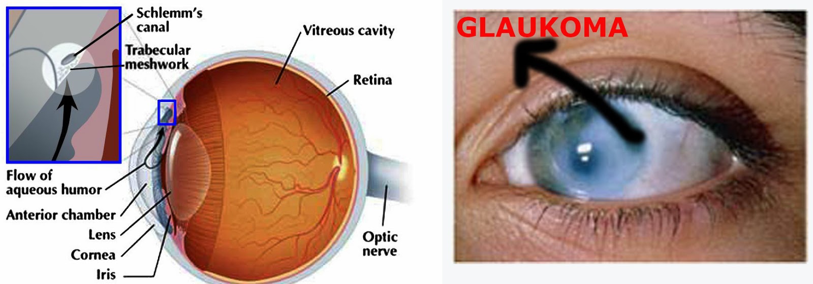 Cara Mengobati Glaukoma Secara Alami Tanpa Operasi - HARY HERBAL INDONESIA