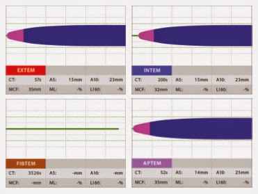 Manuali di Medicina Intensiva: Tromboelastogramma - ROTEM (Capitolo 2 ...
