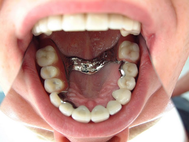 Las prótesis removibles