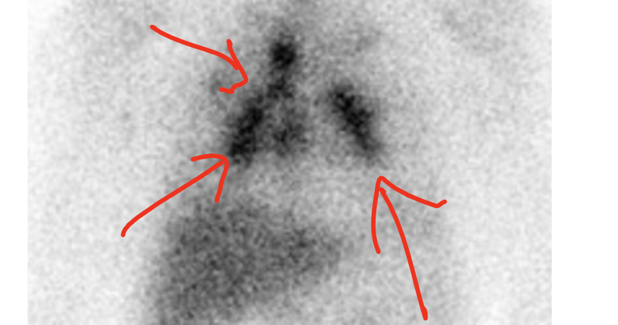 Sarcoidosis : Gallium Scan - Sumer's Radiology Blog