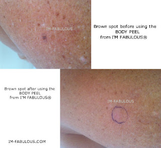 TCA PEELS INFO & REVIEWS: Removing a brown spot with TCA on my leg in 1 ...