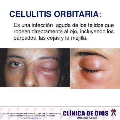 CELULITIS ORBITARIA