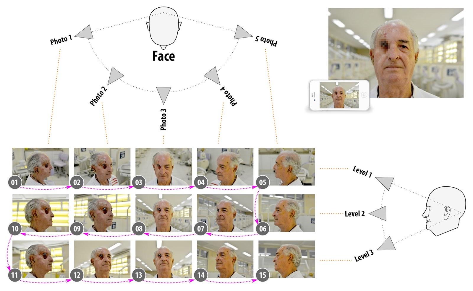 ATOR: Low cost human face prosthesis with the aid of 3D printing