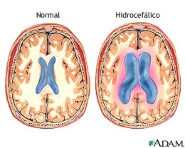 LA CARA DESCONOCIDA DEL CEREBRO: HIDROCEFALIA