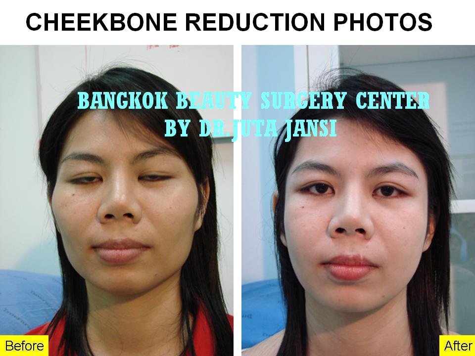 Bangkok Thailand Feminine Surgery