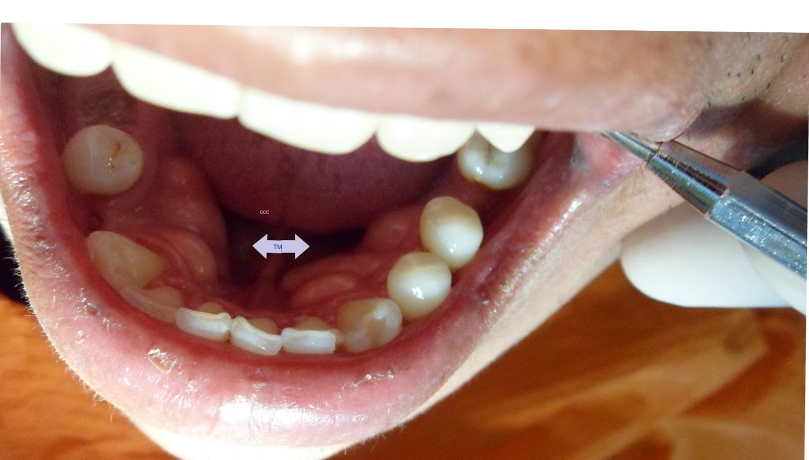 Torus Mandibularis Outside