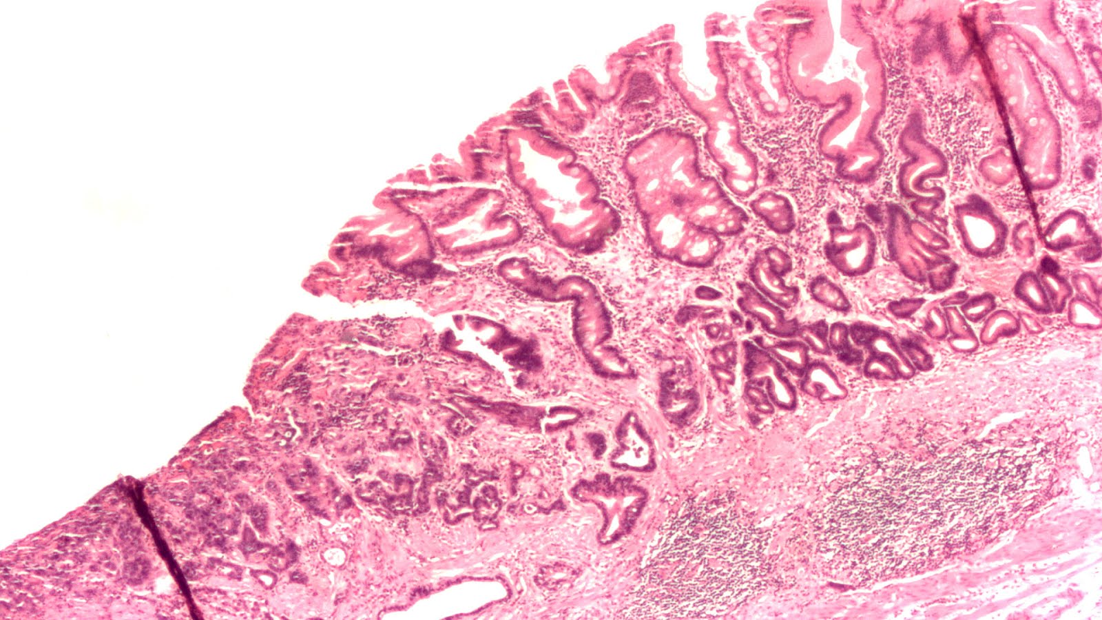 Stomach Ulcers Cancer - Ulcer Choices