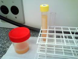 Laboratório nosso de cada dia: Sumário de Urina, Urinálise, EAS.