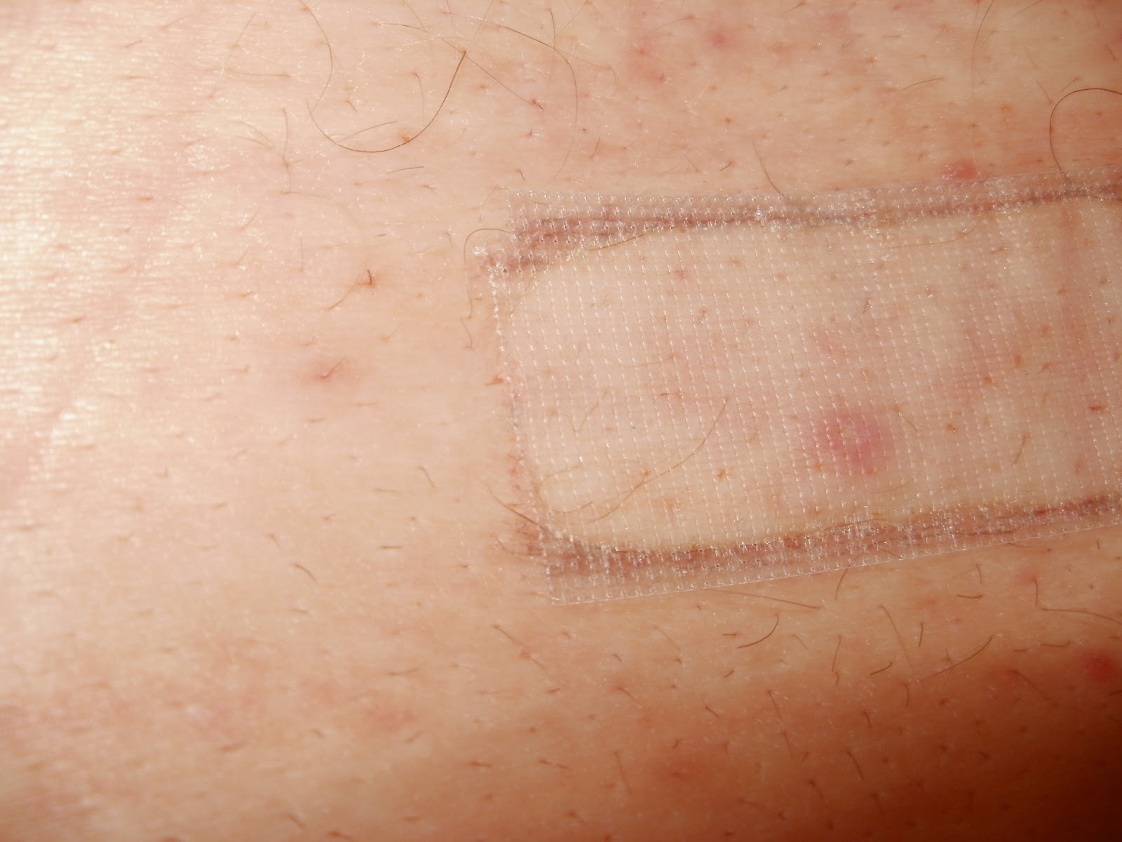 Comrade Kevin's Chrestomathy: Interstim Surgery, Phase One