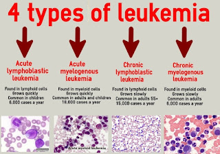 Leukemia – A type of Blood Cancer