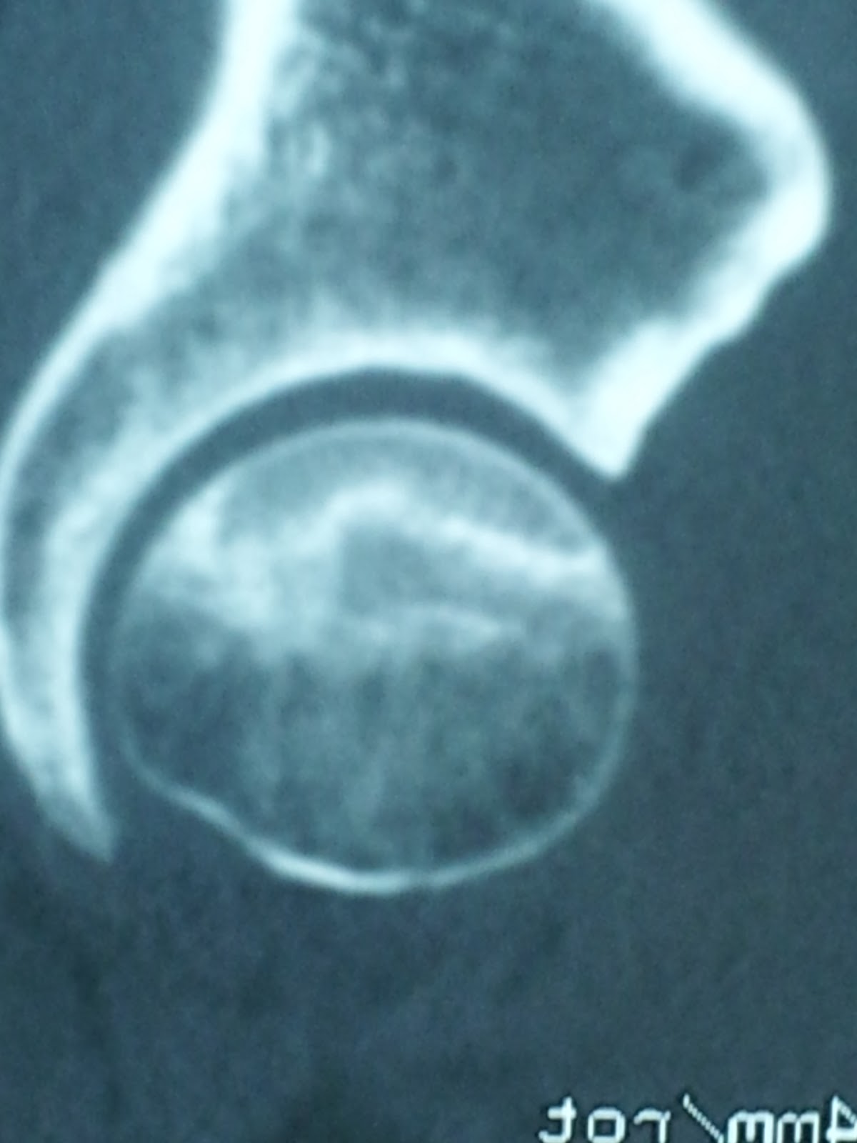 AVASCULAR NECROSIS OF HIP - CORE DECOMPRESSION & BONE MARROW INJECTION ...