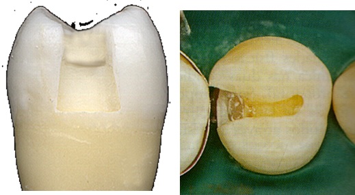 Saúde da Boca: NOMENCLATURA E CLASSIFICAÇÃO DAS CAVIDADES