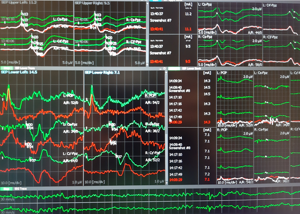 Neurophysiology Plus Iceland: D wave IONM in Iceland. Third case ...