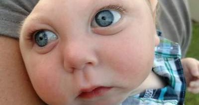 pediatric neurology: Microhydranencephaly