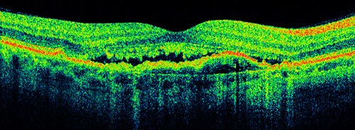 DEGENERACION MACULAR : DMAE SECA. OCT DE CONTROL
