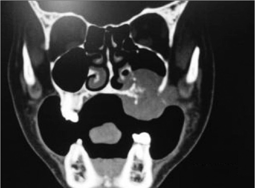 SUHASIS ONLINE: Non-Hodgkins lymphoma of maxilla: A rare entity