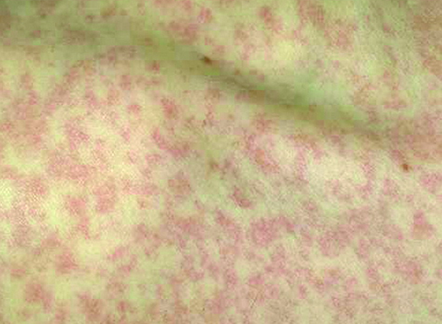 Viral Meningitis Rash