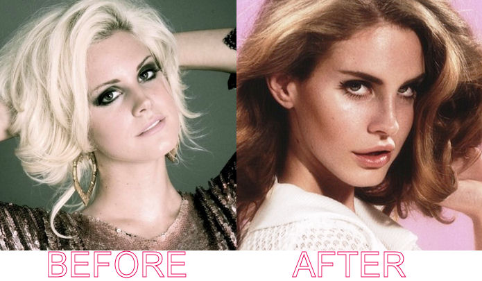 Lana Del Rey Surgery