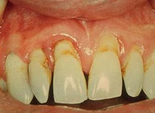 periodontitis