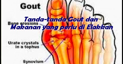 Badan Sihat Hati Ceria: Tanda-tanda gout dan pemakanan sesuai untuk ...
