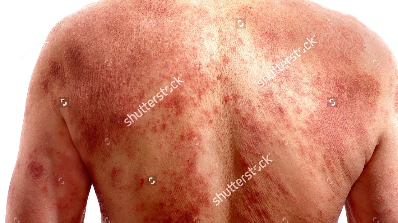 African American Skin Rashes American Choices